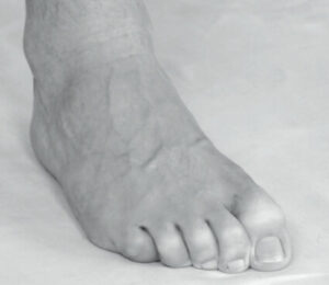 Symptômes de la spasticité et syndrome spastique Informations spasticité