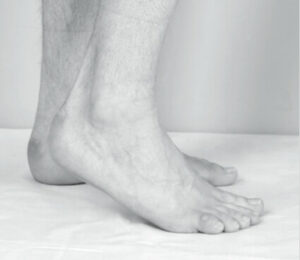 Spastik-Syptome & spastisches Syndrom | Spastik-Info