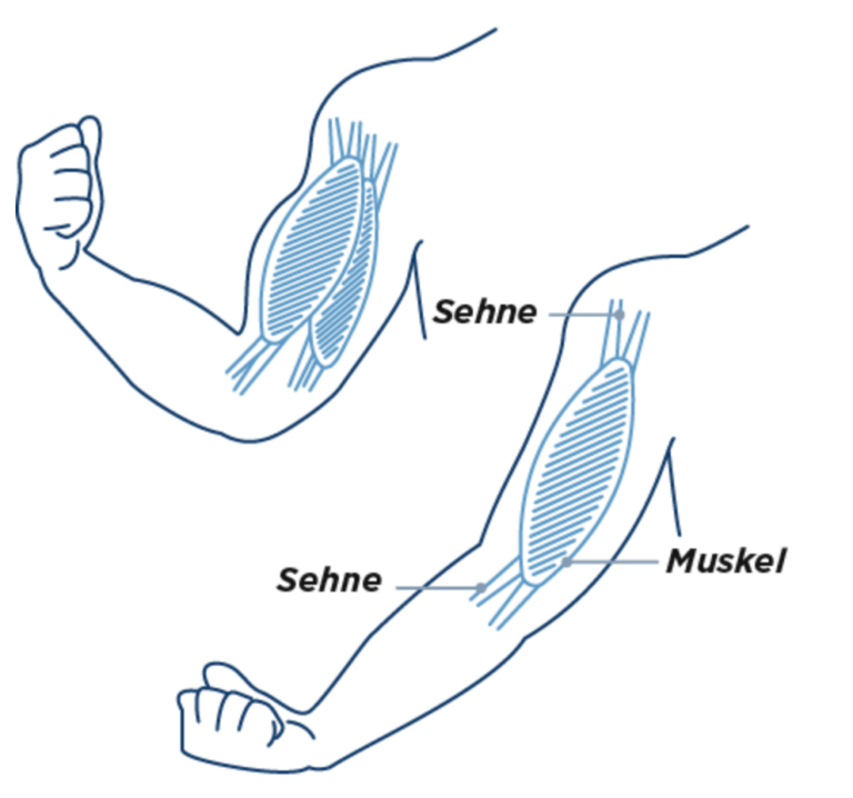 Symptômes de la spasticité et syndrome spastique Informations spasticité